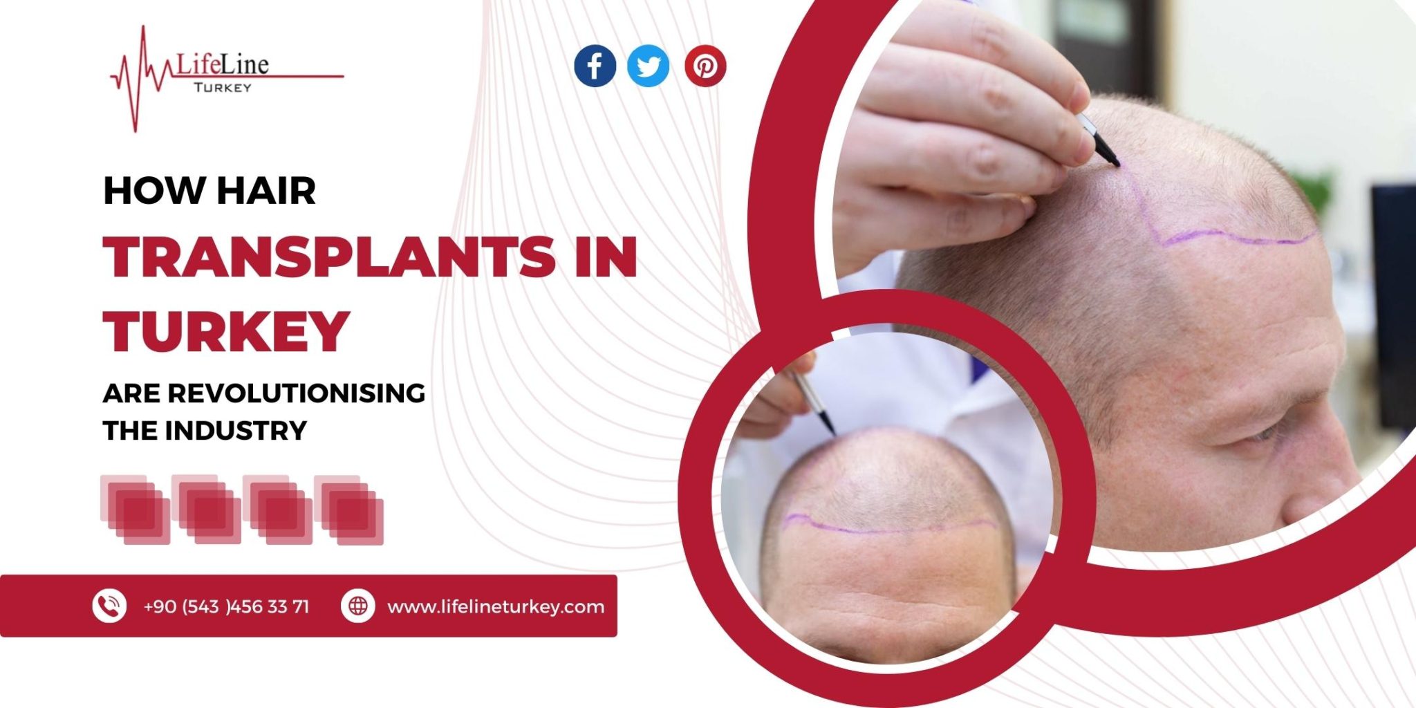 How Hair Transplants in Turkey Are Revolutionising the Industry